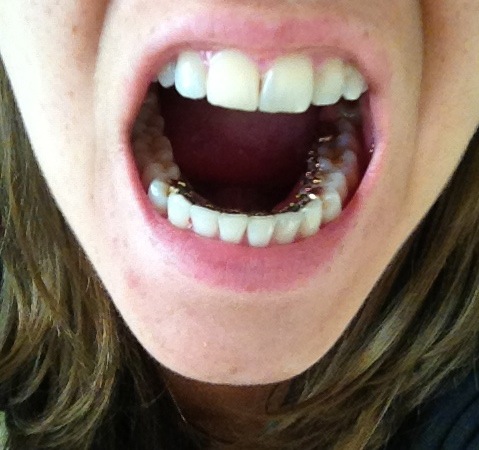 B's Beauty Blog: Incognito braces - train tracks for adults!