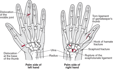 ithoxs: Five Most Common Hand Injuries