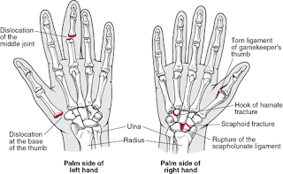 ithoxs: Five Most Common Hand Injuries