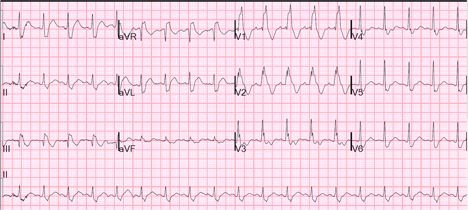 Dr. Smith's ECG Blog: PseudoSTEMI and True ST elevation in Right Bundle ...