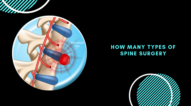 Types and Measures of Your Spine Surgery
