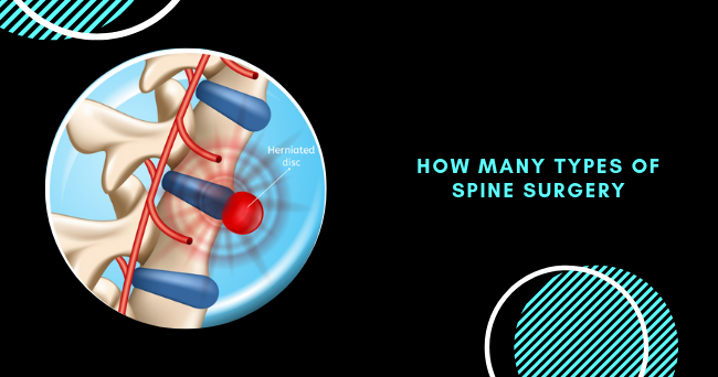 How Many Types of Spine Surgery