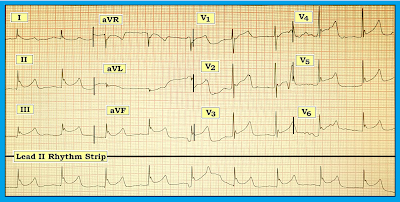 ECG Interpretation: ECG Blog #149 (ST Elevation - J-Point - Osborn ...