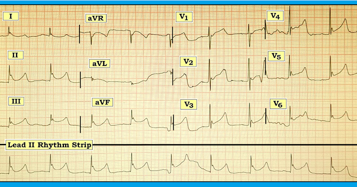 ECG Interpretation: ECG Blog #149 (ST Elevation - J-Point - Osborn ...