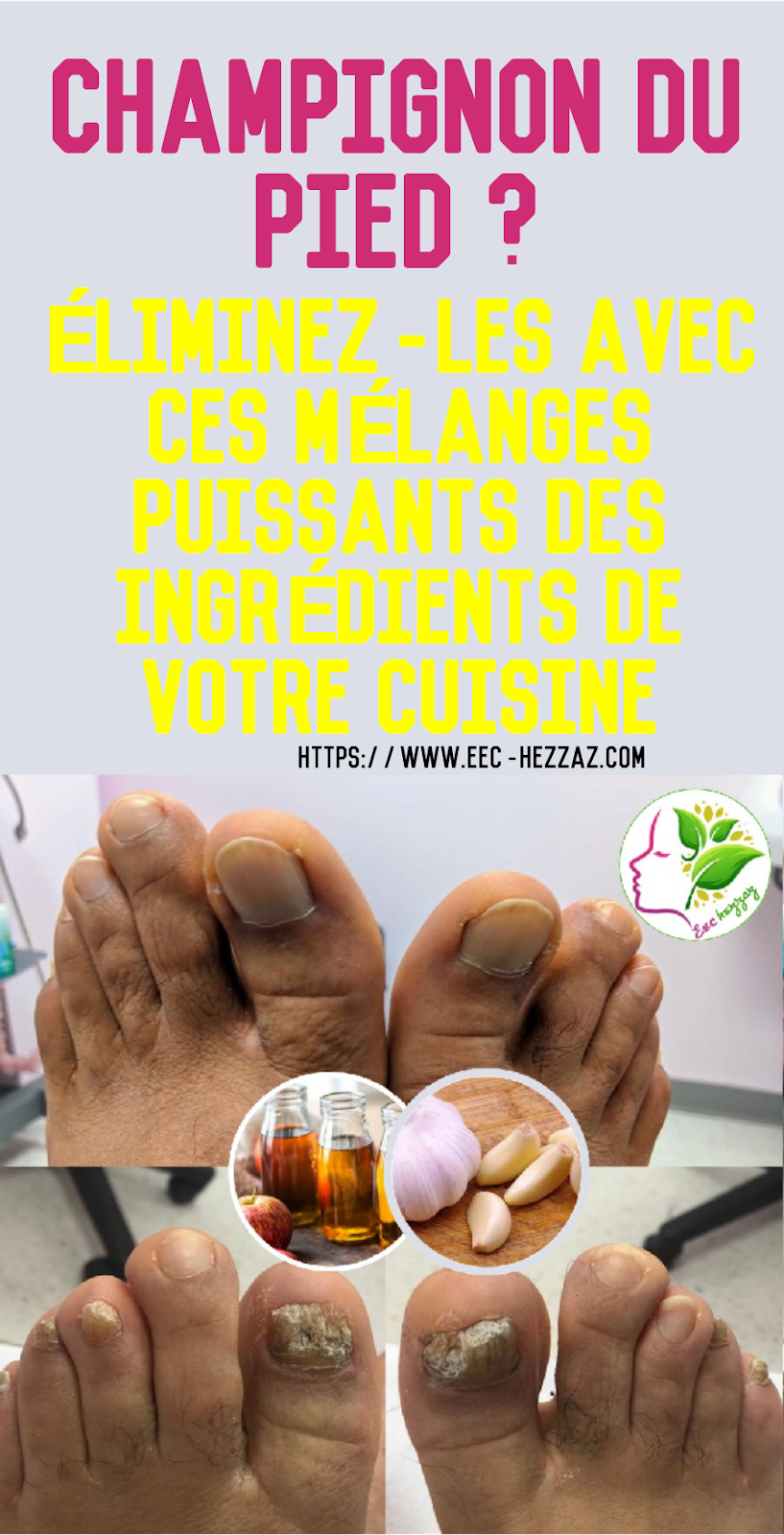 Champignon du pied? Éliminez-les avec ces mélanges puissants des ...