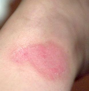 The Franken-Ankle Chronicles: Indian Burn