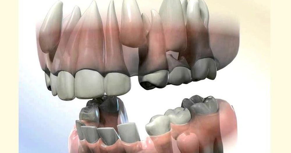 ORTHODONTICS : Serial extraction of primary teeth - odontobebe