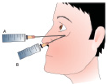 Ocular Anasthesia - Peribulbar Block