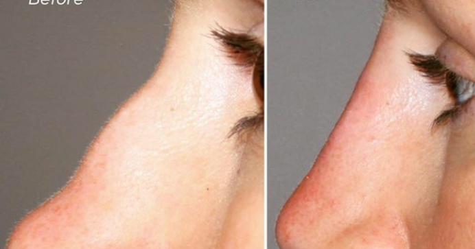 Selston Cosmetic Clinic: Correct Your Bumpy Uneven Nose with Dermal ...