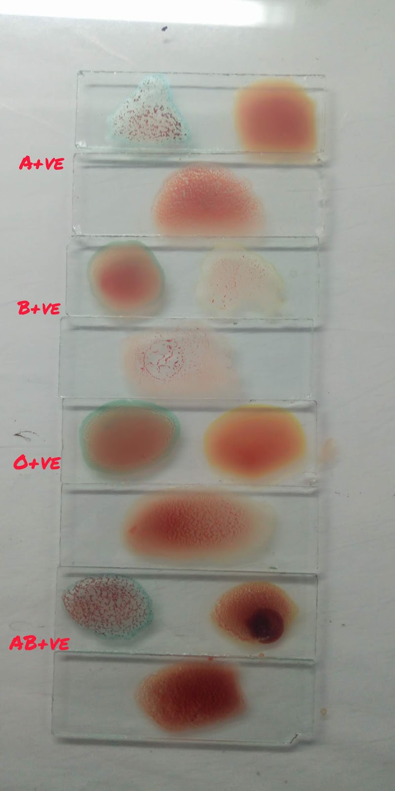 ABO blood grouping test by slide or tube method ~ NIRAMYAM BHARAT