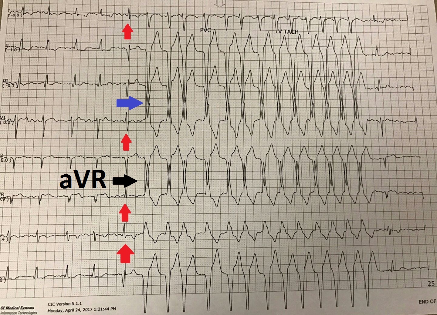 ECG Rhythms: AF with WCT