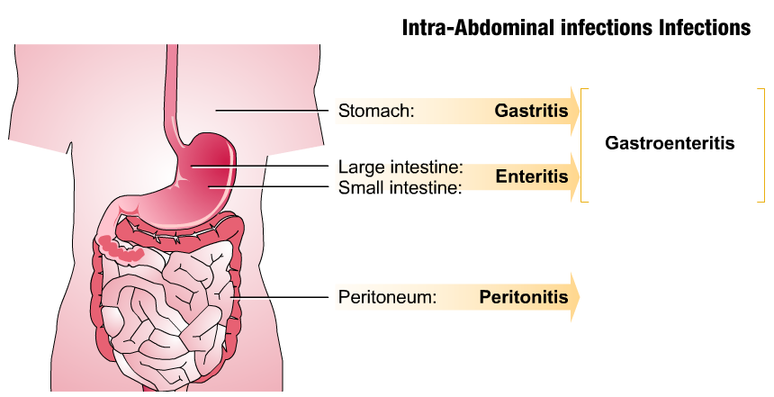 Intraabdominal Infections