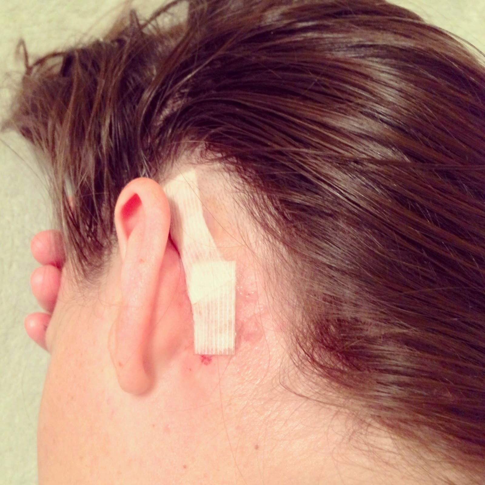 ~Learning to Hear~: Revision Surgery (Part 3): Post-Op