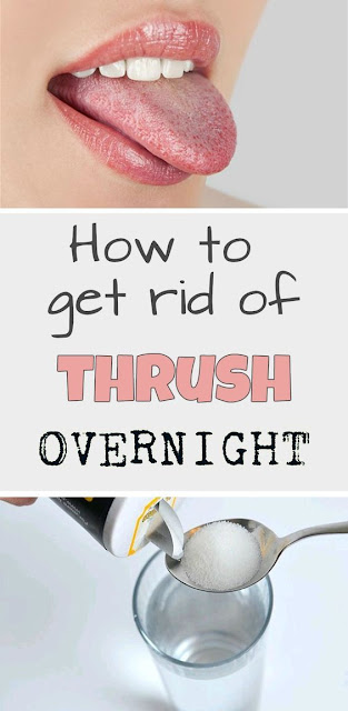 9 Methods for How to Battle Oral Thrush | Healthcare Topic