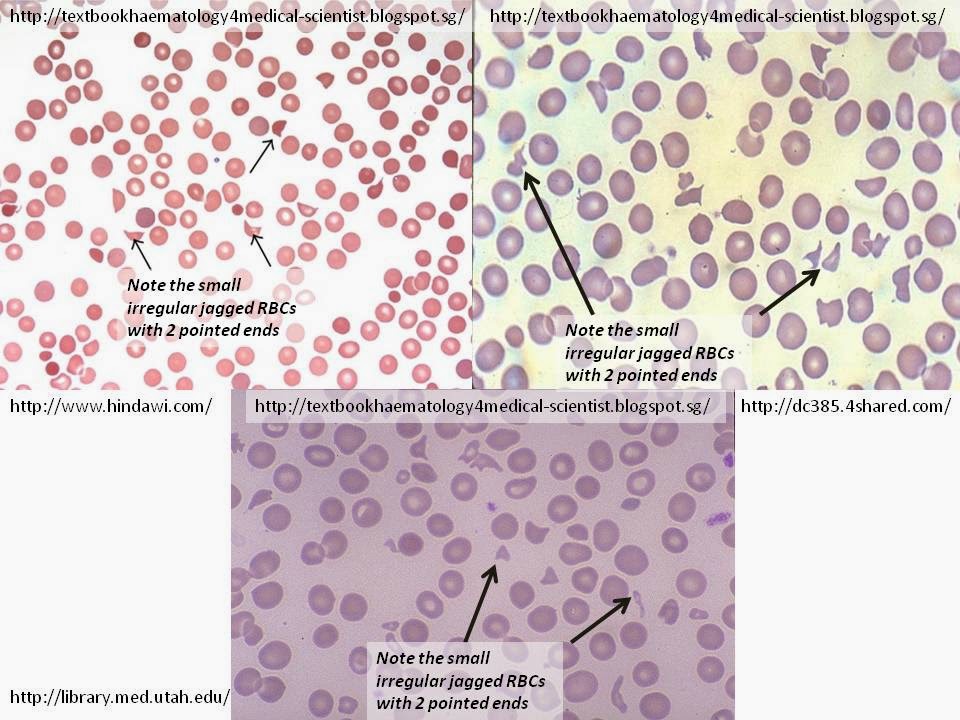 Haematology in a NutShell: Fragmented RBCs (Schistocytes)