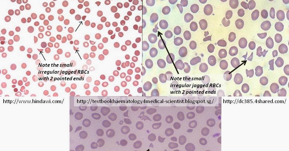 Haematology in a NutShell: Fragmented RBCs (Schistocytes)