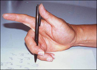 Writer's Cramp - Causes, Symptoms, Diagnosis & Ayurvedic treatment - Dr ...