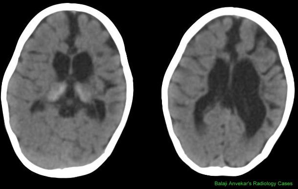 Dr Balaji Anvekar FRCR: Hyperdense thalami : Perinatal ischemia
