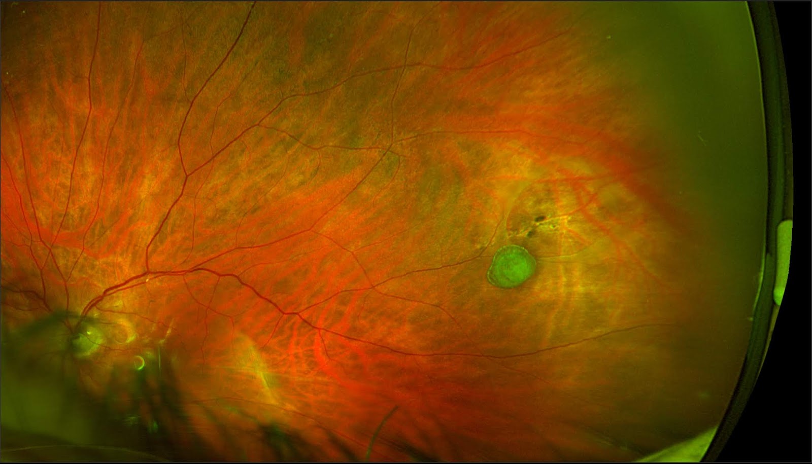 Operculated Retinal Hole