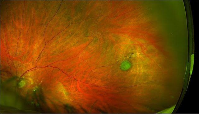 Sonoran Desert Eye Center: LARGE RETINAL HOLE WITH OPERCULUM