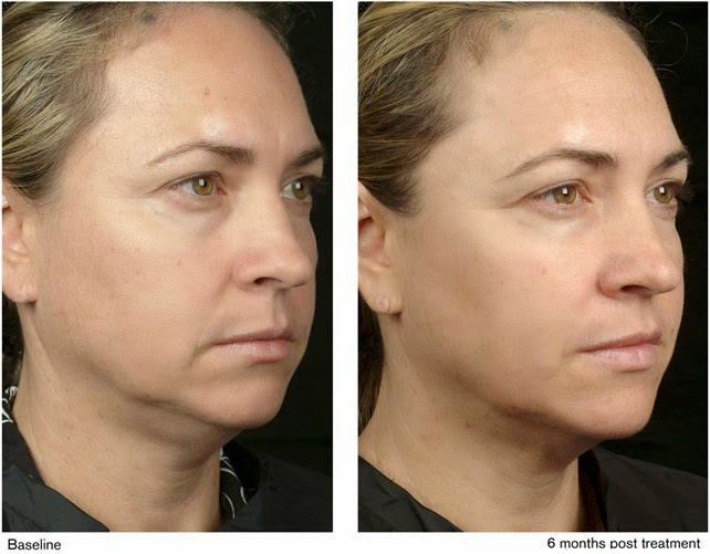 Perfect Body Laser and Aesthetics: Thermage at Perfect Body Laser