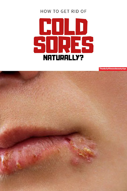 How To Get Rid Of Cold Sores Naturally how-to-get-rid-of-cold-sores-naturally