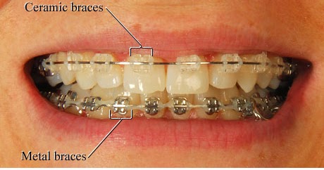 Expert Dental Care and Treatment: An orthodontist’s View on Metal And ...