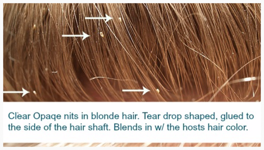 Nit Picky Professional Lice Treatment: What Are Nits?