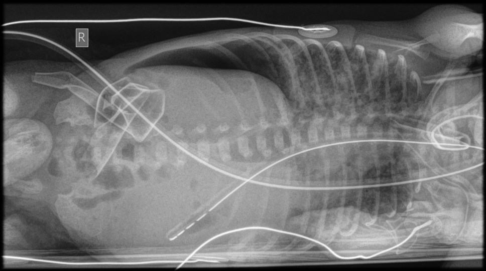 Neonate with abdominal distension