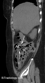 RiT radiology: Blunt Traumatic Colon Perforation