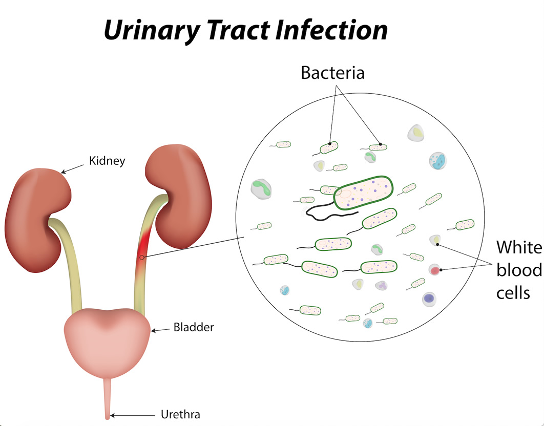 URINARY TRACT INFECTION