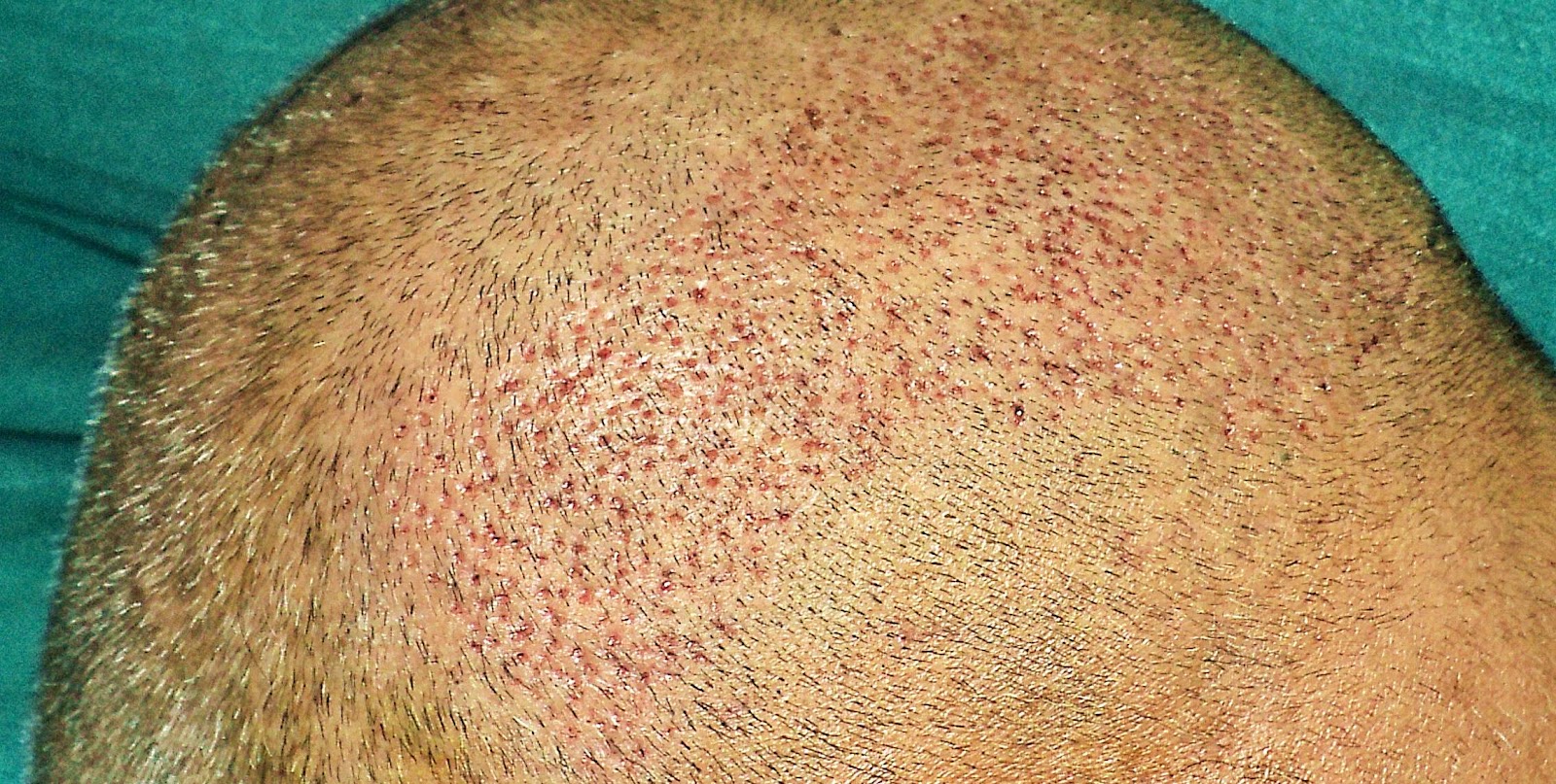 Is FUE the Best Hair Transplant Technique?