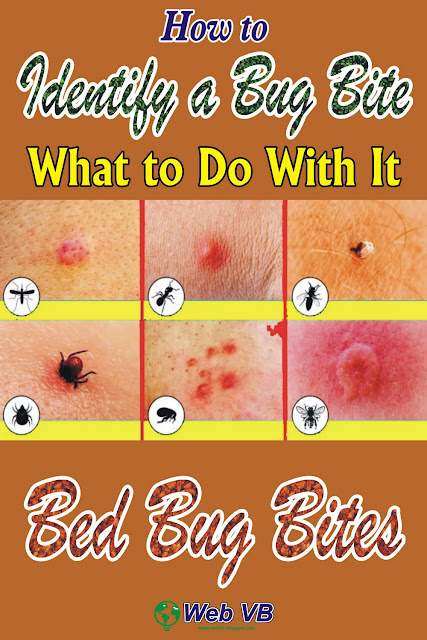 Bug Bite Identifier Chart
