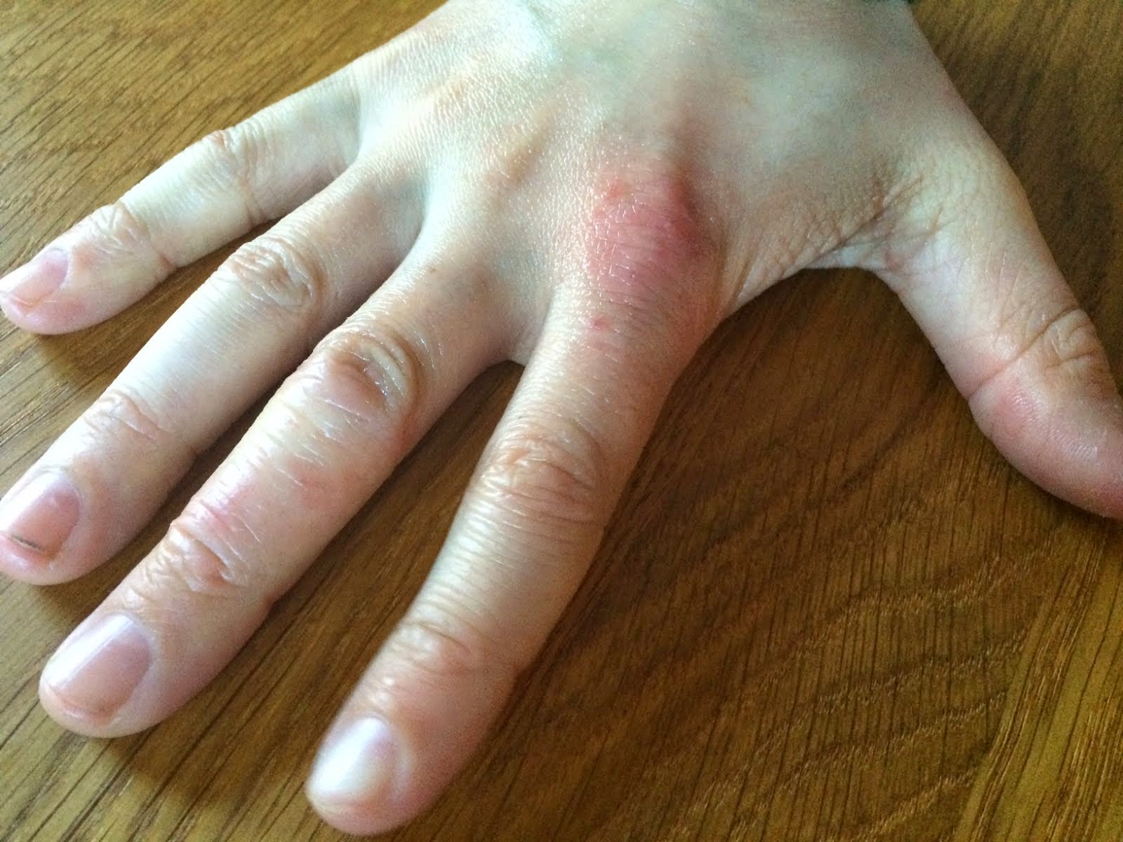 SØSKEN: Eksem på hender og fingre