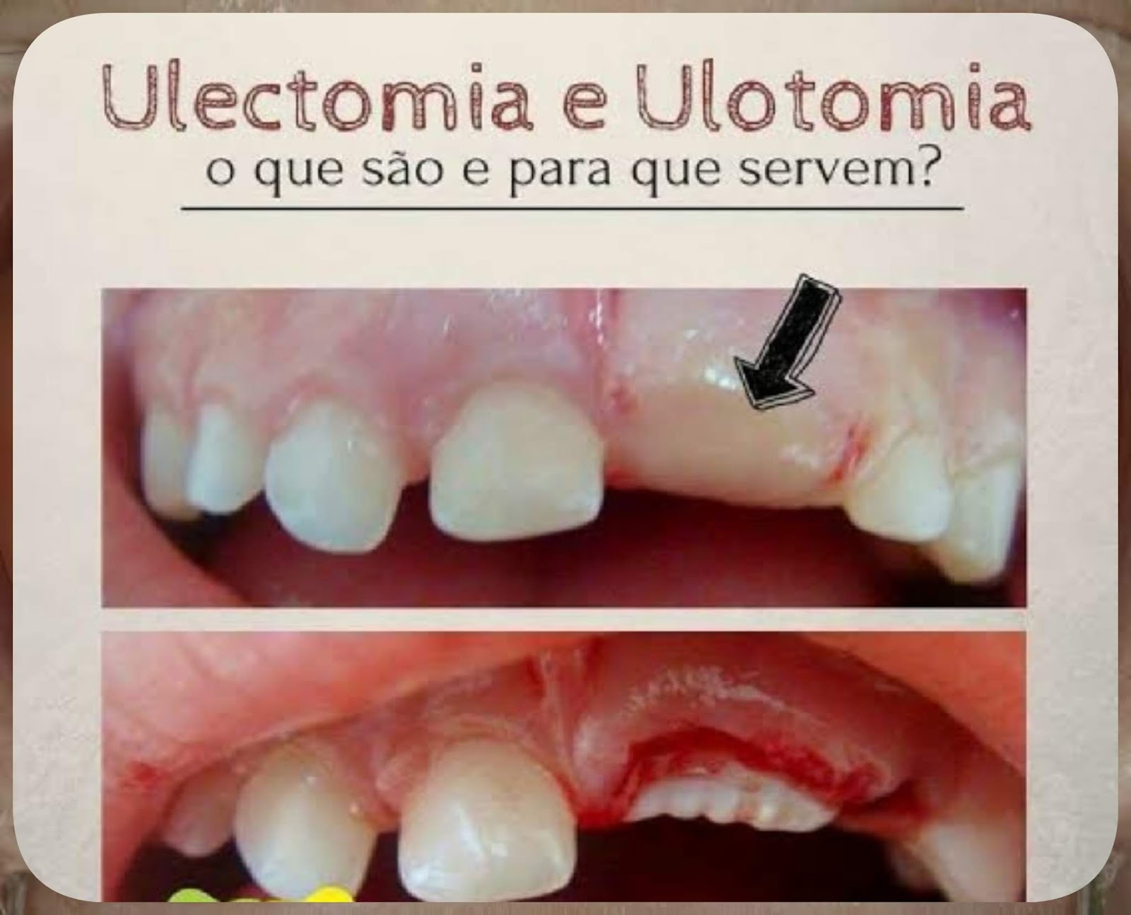Ulectomia Passo A Passo - RETOEDU