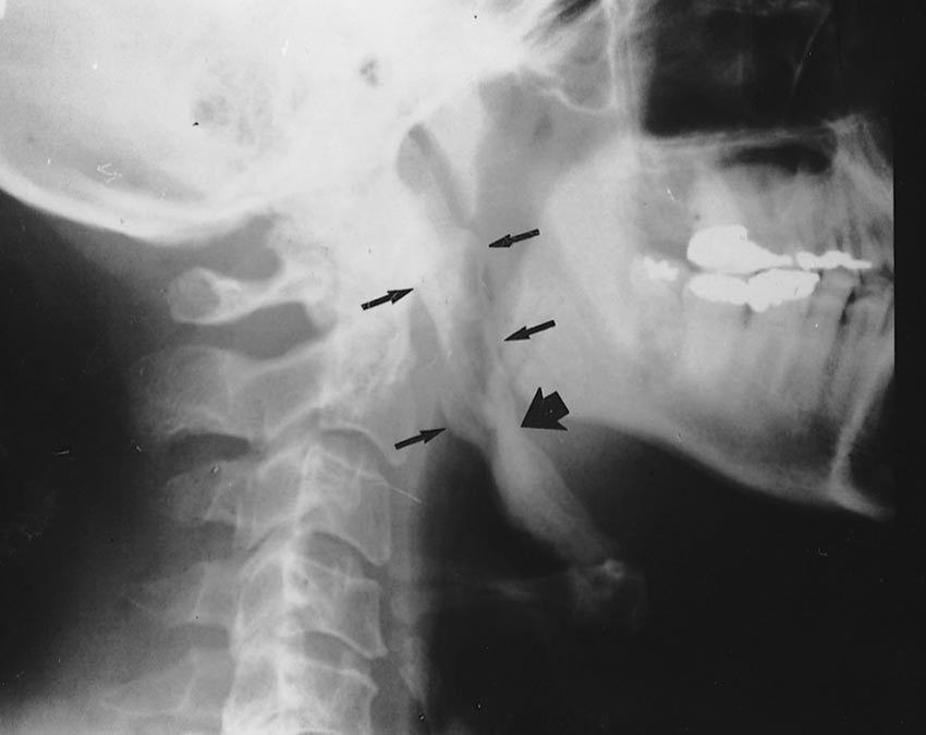 Skull and Spine: Eagle syndrome