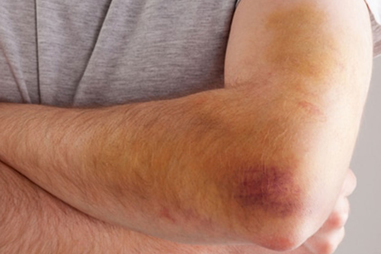 9 warning signs of toxins build up in your liver?? Check iT OUT