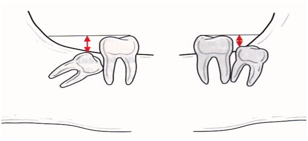 Dentistry and Medicine: Surgical management of Unerupted and Impacted teeth