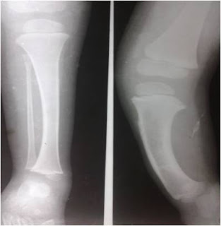 FIBULAR HEMIMELIA - Sumer's Radiology Blog