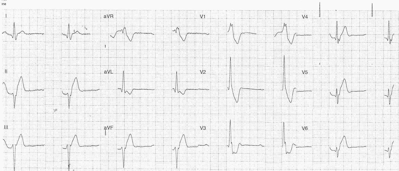ECG of the Week: ECG of the Week - 24th October 2016 - Interpretation