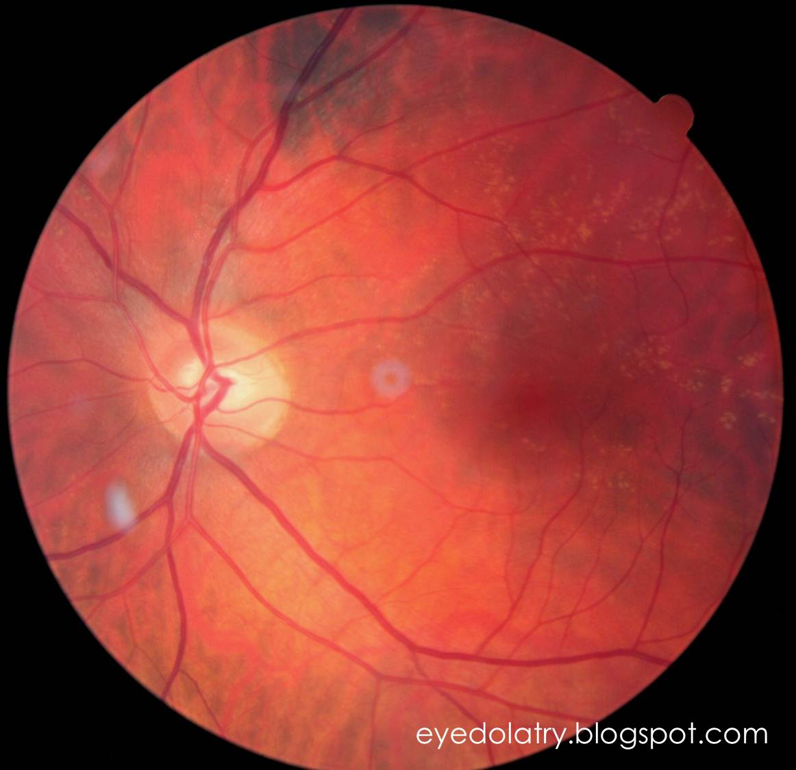 Retinal Photography II - Eyedolatry