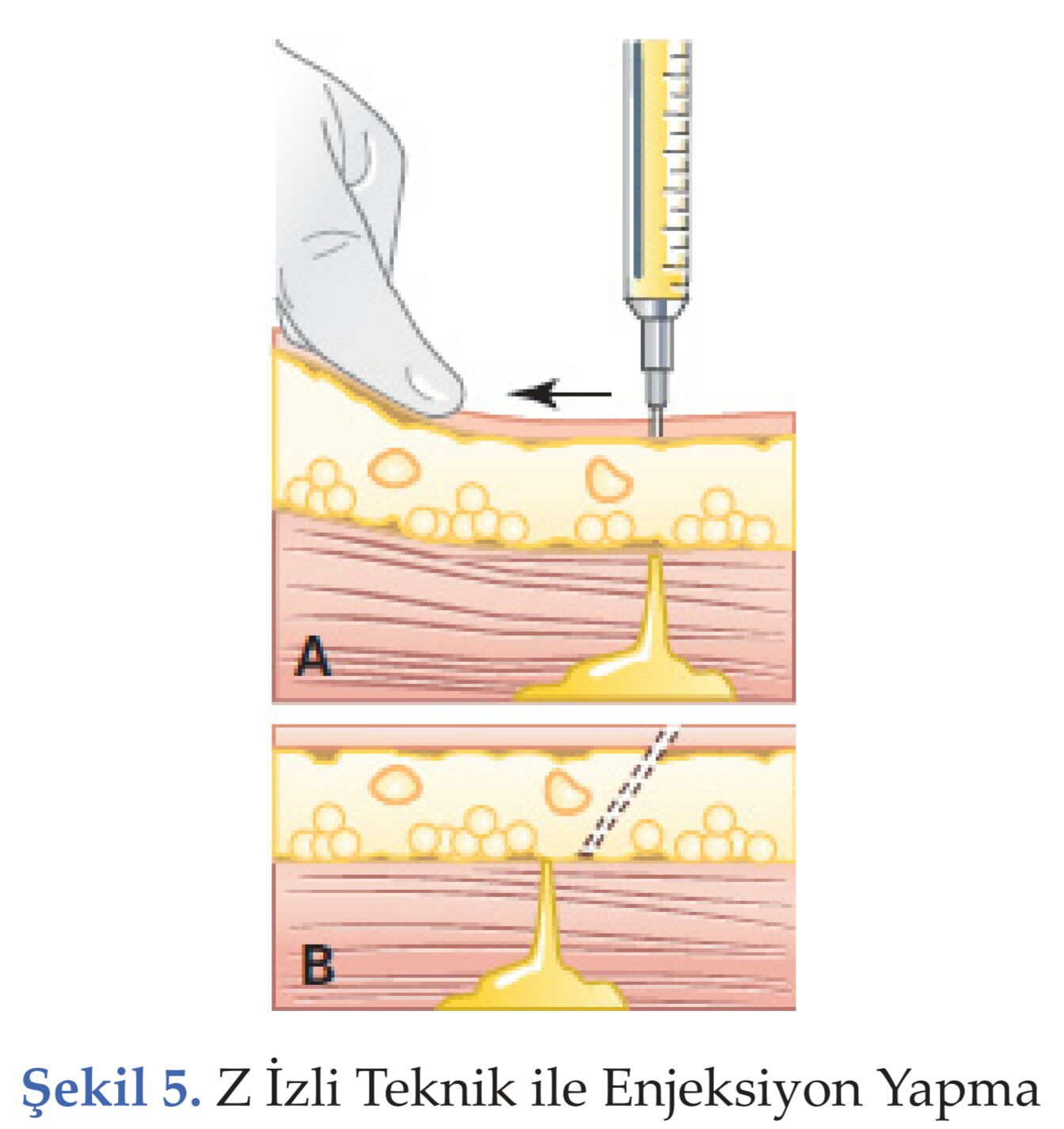 INTRAMUSKULER ENJEKSİYON UYGULAMASI: ENJEKSİYON UYGULAMA TEKNİKLERİ
