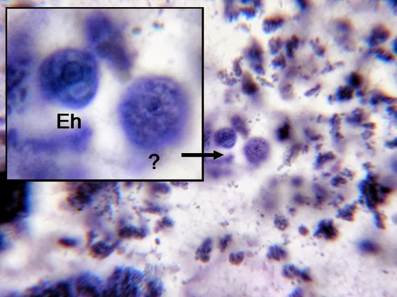 Fun With Microbiology (What's Buggin' You?): Entamoeba polecki