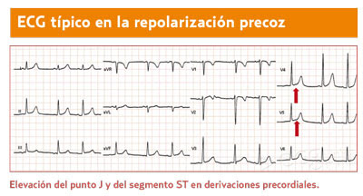Hallazgos Normales en ECG Atletas: International recommendations for ...