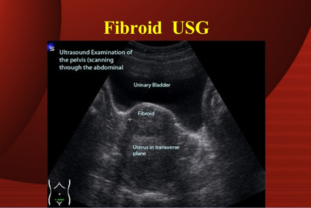 MEDICAL ULTRASOUND/FIBROMYOMA