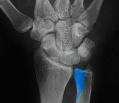 OSSA CARPALIA ©: noviembre 2011