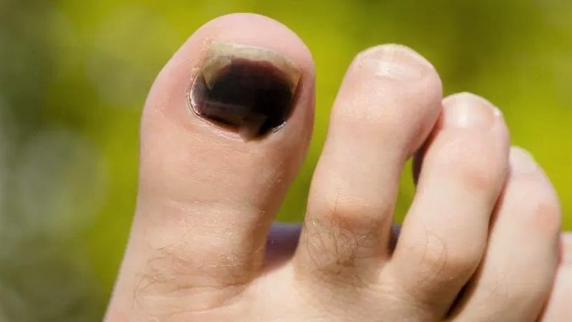 Toenail (Subungual Melanoma) Cancer Symptoms - What is Cancer