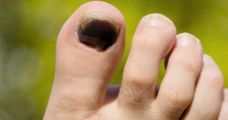 Toenail (Subungual Melanoma) Cancer Symptoms - What is Cancer