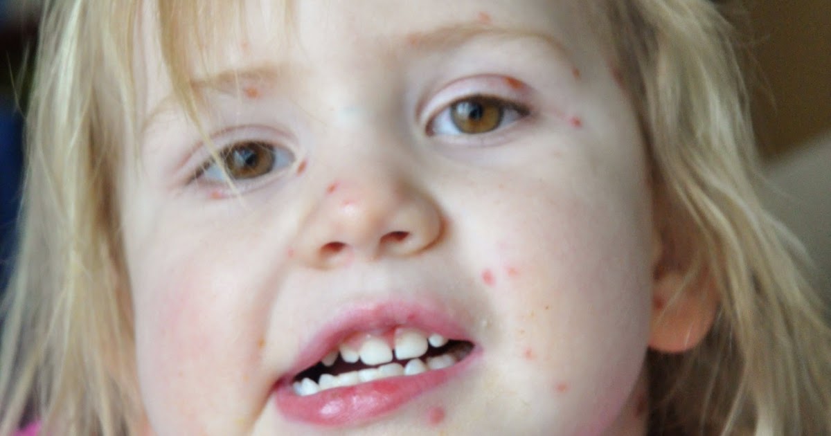 Phyl's Blog: Chicken pox - Day 9