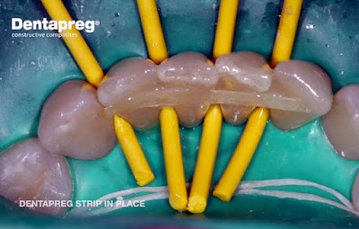 PERIO SPLINTING: Dentapreg fiber strip step by step - Dr. Eric Van Zytveld